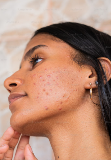 ACNE - Drainage lymphatique Renata Franca et Manuela ShalaParis